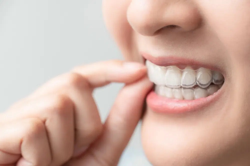 Can You Get Invisalign With Wisdom Teeth? | Learn More